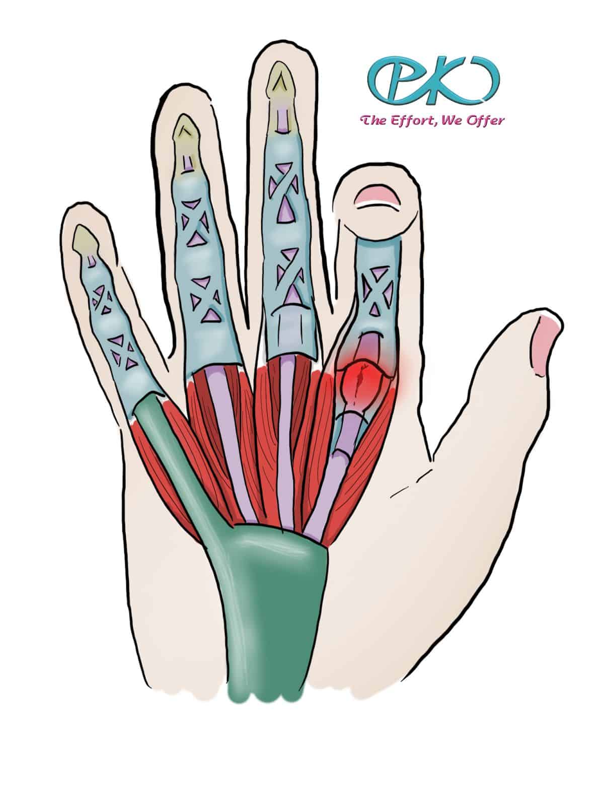 Trigger finger นิ้วล็อค – PKPT Clinic